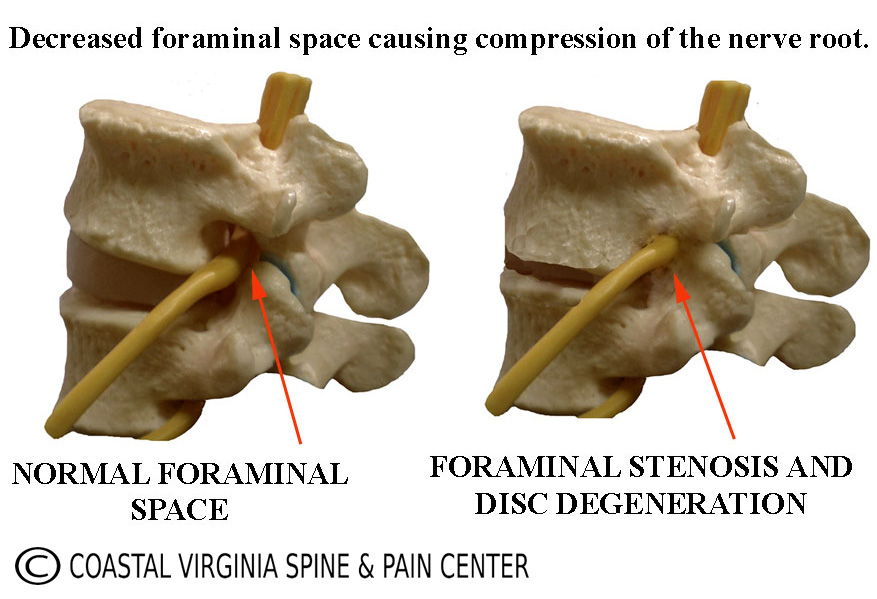 Spinal Stenosis Coastal Virginia Spine Pain Center